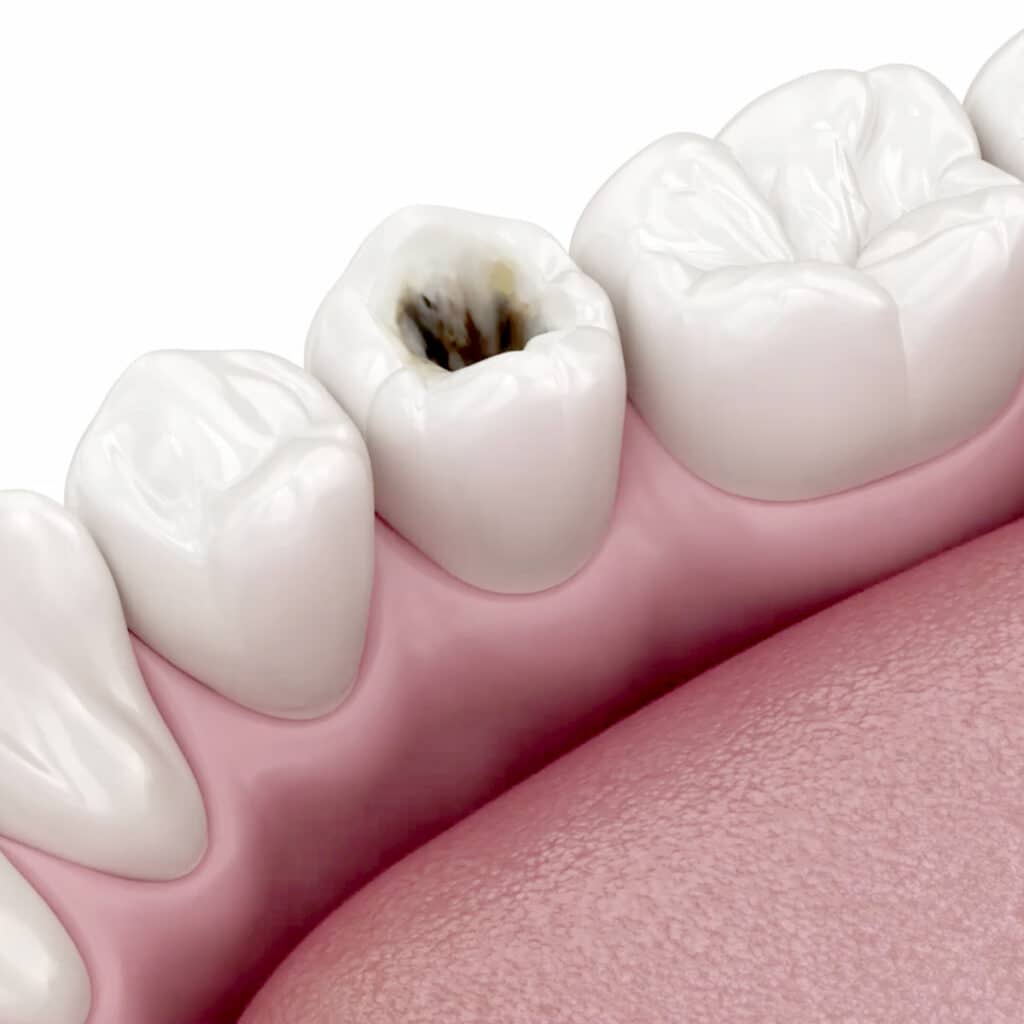 Treating deep caries correctly DR. HAGER | Dentists