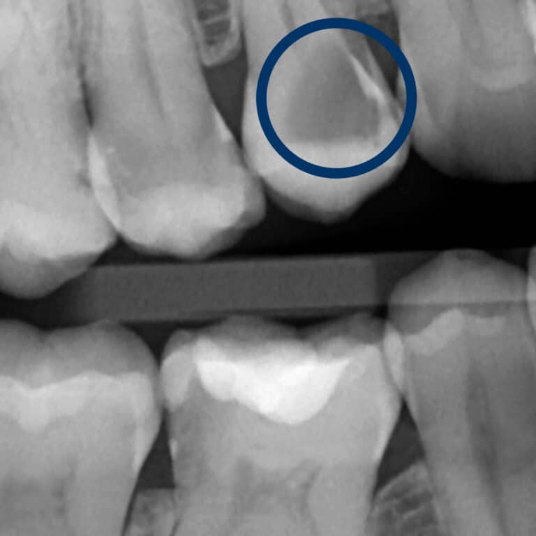 Treating deep caries correctly DR. HAGER | Dentists