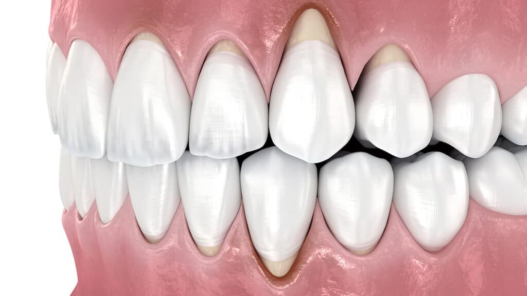 Parodontitis richtig behandeln – DR. HAGER | Zahnärzte