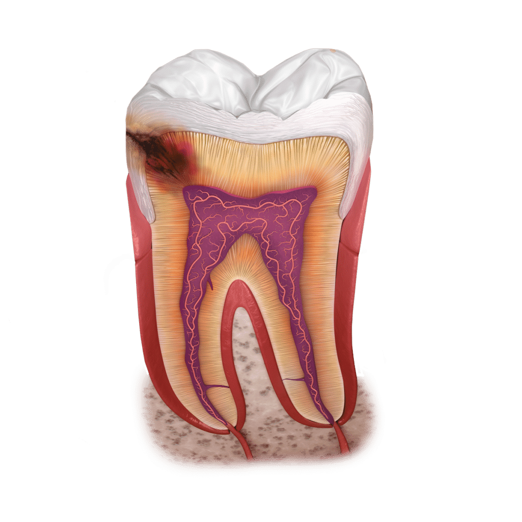 Tiefe Karies richtig behandeln – DR. HAGER | Zahnärzte